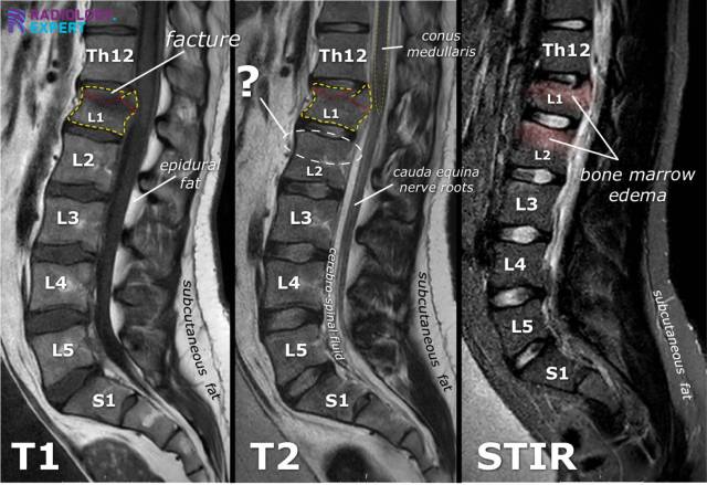 MRI Lumbar Spine